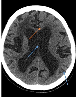 White Matter Hyperintensity and Vascular Disease from Biological Basis to Clinical Significance